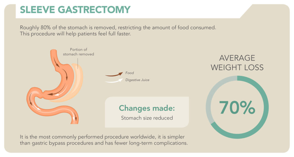 Bariatric Surgery - Island Hospital