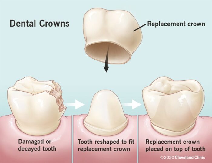 A Guide to Dental Crown: Cap Your Tooth, Uncap Your Smile