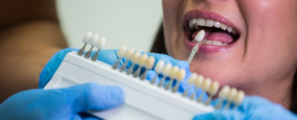 A Guide to Dental Crown: Cap Your Tooth, Uncap Your Smile