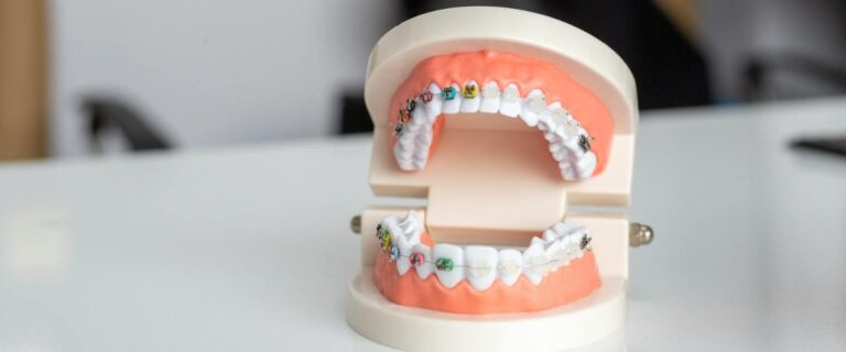 Conventional Braces: Benefits, Drawbacks, Procedure & Aftercare