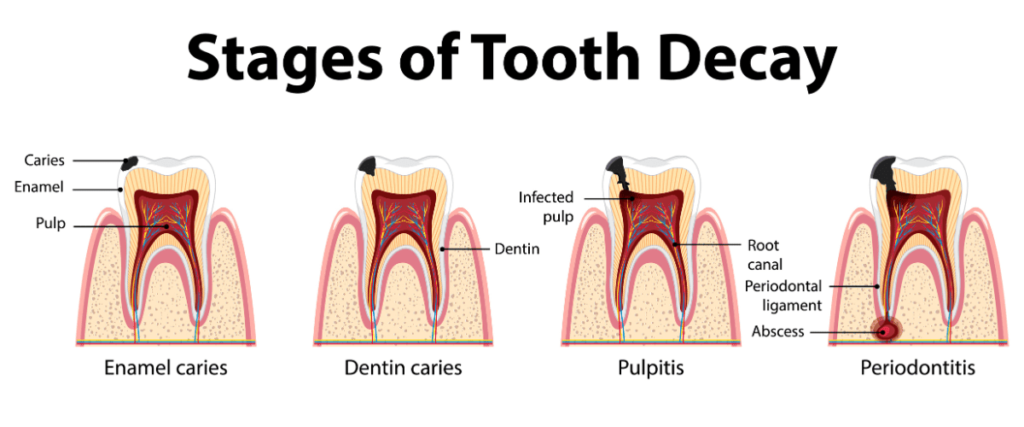 A Brighter Smile Starts Here: How to Prevent Tooth Decay