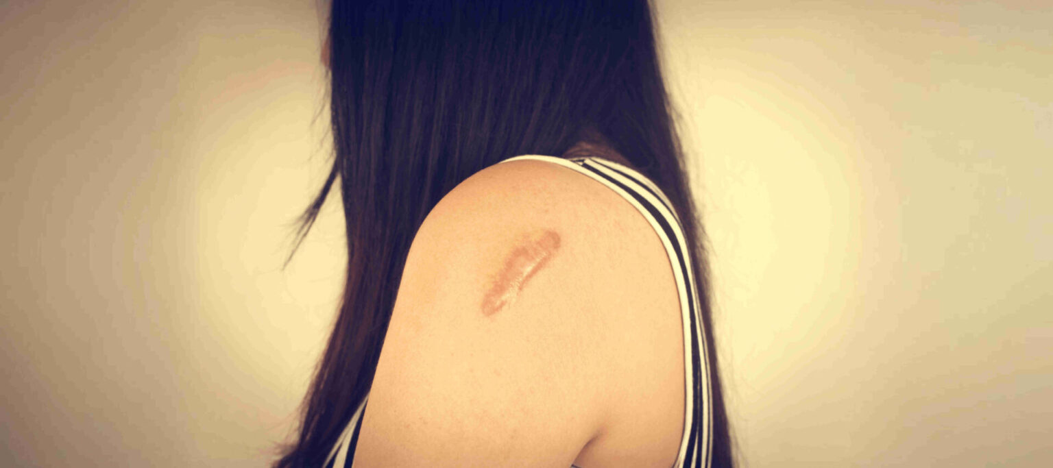 An In-Depth Guide to Keloid Treatment