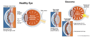 Glaucoma vs. Cataracts: Which Eye Condition Are You At Risk For?