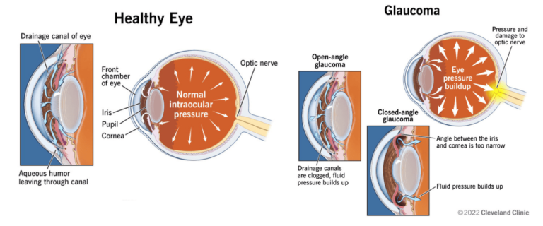 Glaucoma vs. Cataracts: Which Eye Condition Are You At Risk For?