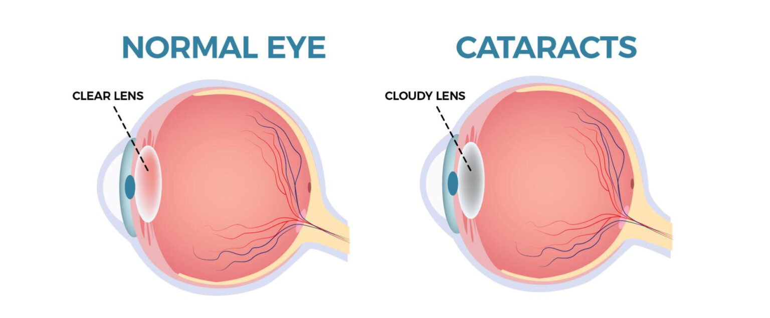 Glaucoma vs. Cataracts: Which Eye Condition Are You At Risk For?
