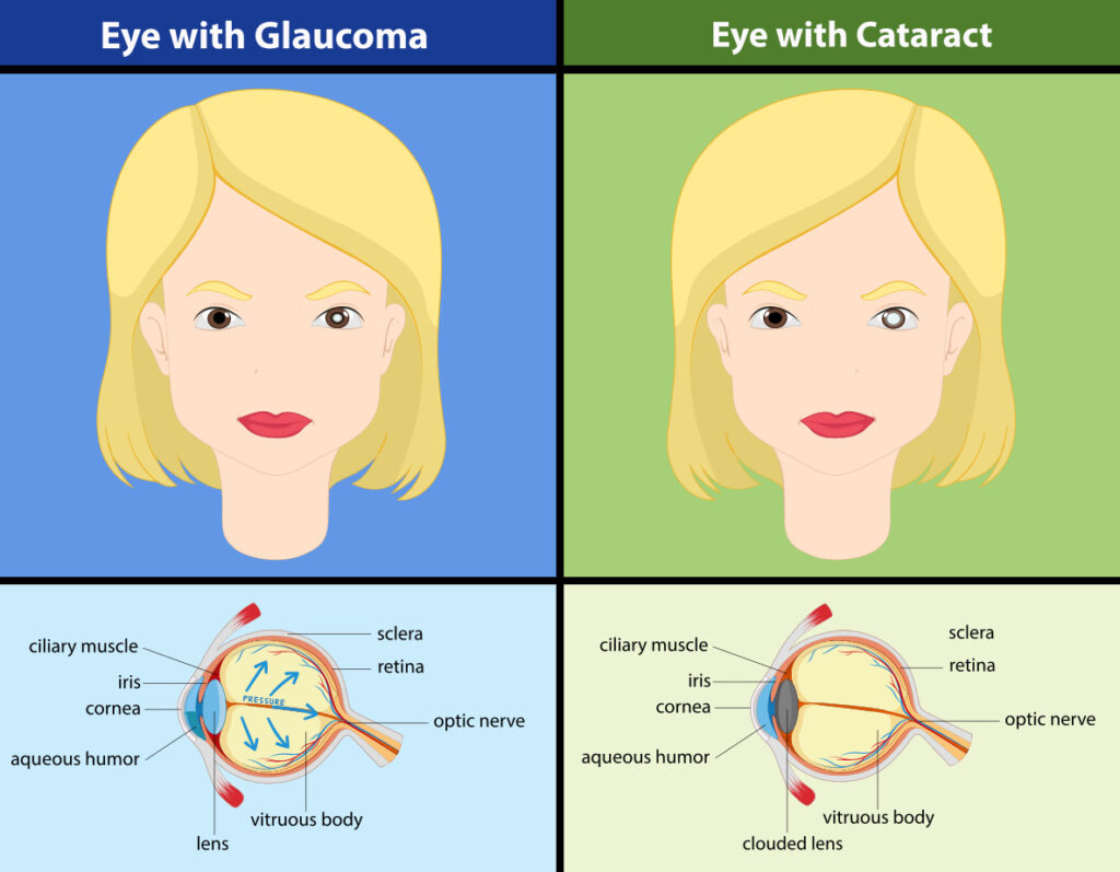 Glaucoma vs. Cataracts: Which Eye Condition Are You At Risk For?