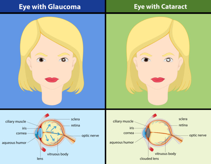 Glaucoma vs. Cataracts: Which Eye Condition Are You At Risk For?