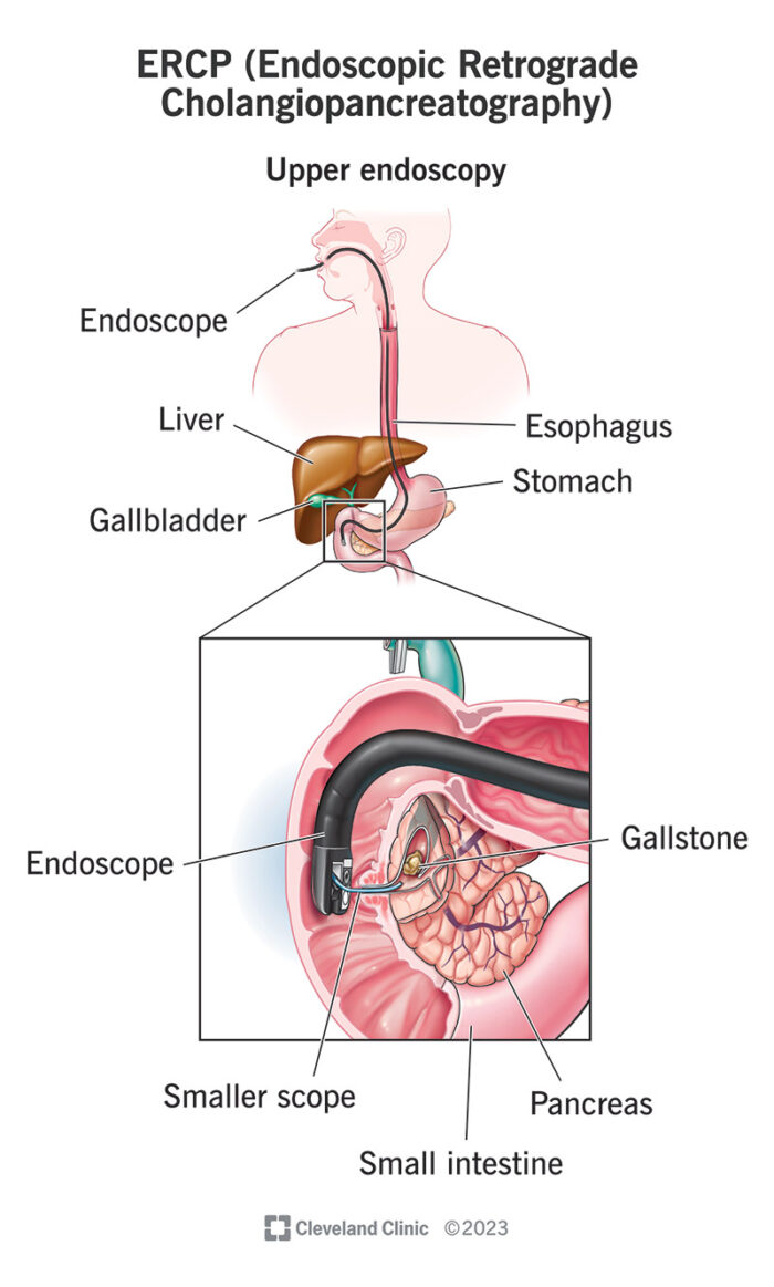 Everything You Need to Know About Gallbladder Stone Removal in Malaysia ...