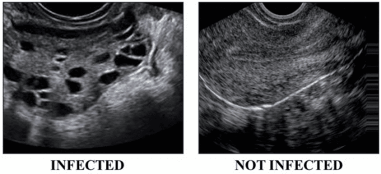 Top 5 PCOS Treatments Your Gynecologist Recommends (Diet & Drugs)
